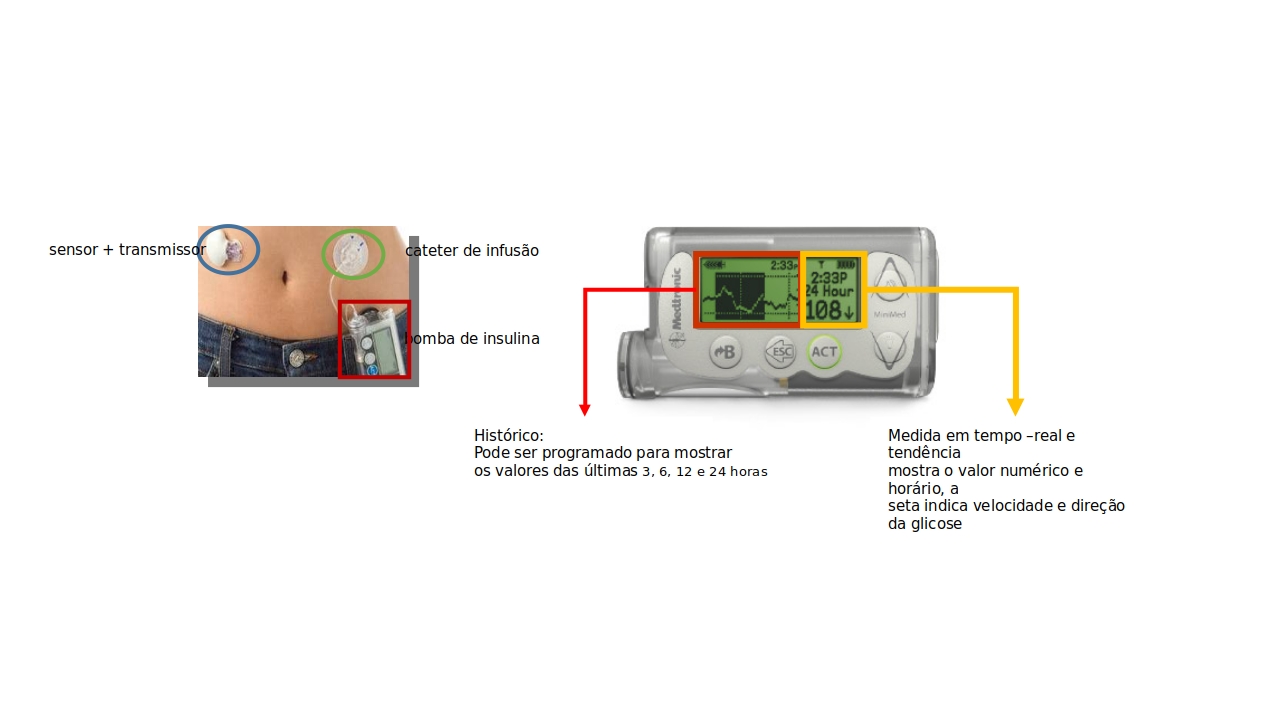 Sensor de glicemia: verdades e mito – Consultório Médico